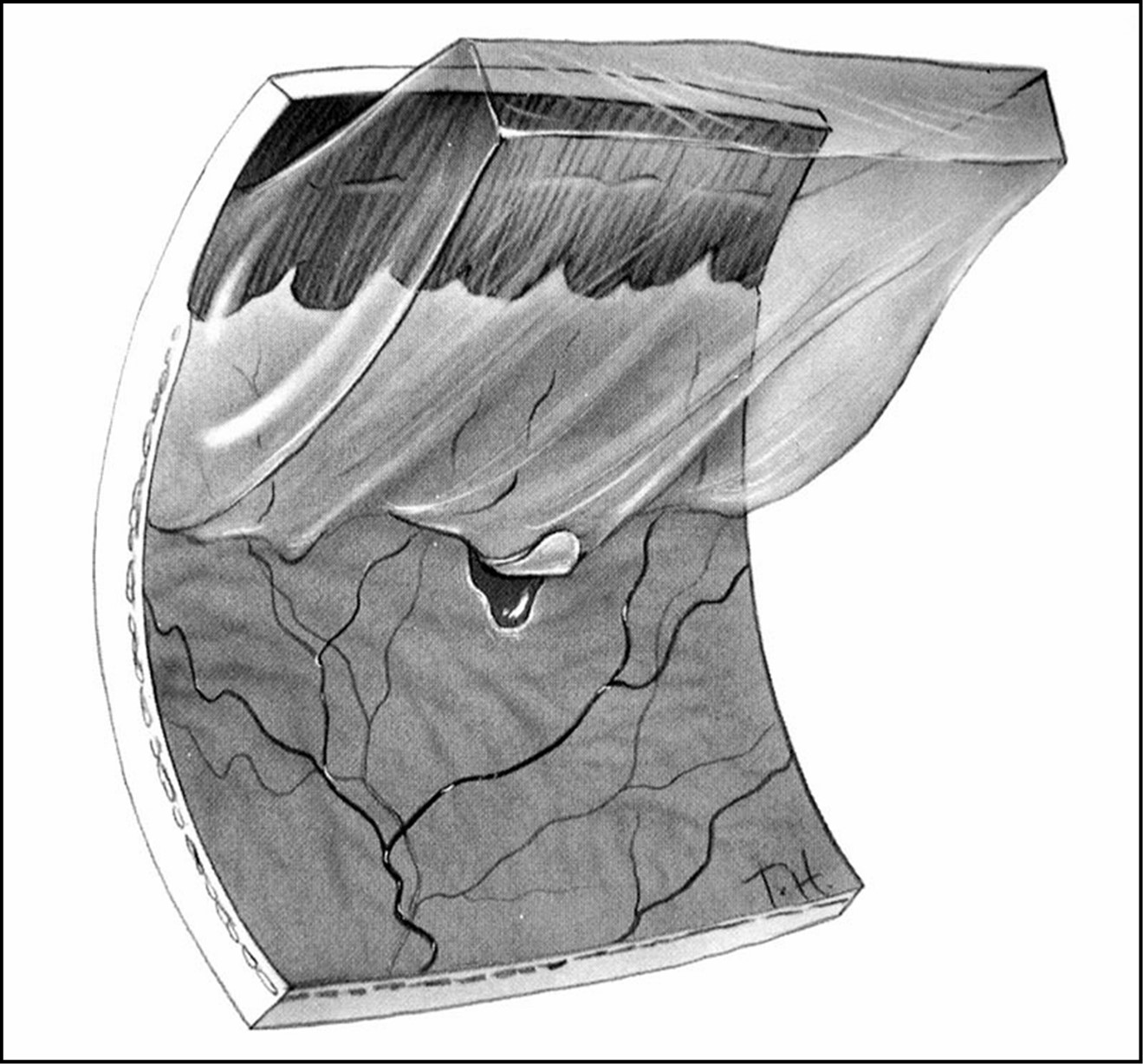 Chirurgie de la rétine, en quelles circonstances ? - Pôle Ophta Le Mans 72
